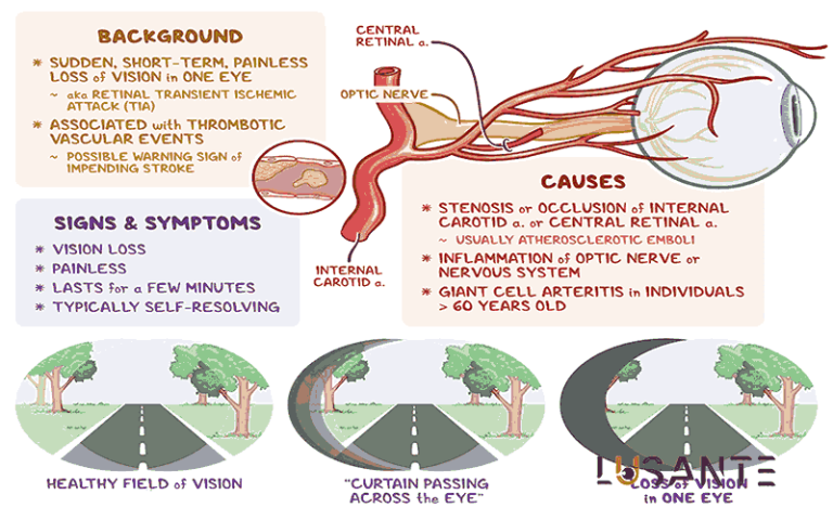 Transient Vision Loss: white out vs. black out | 10 Causes, Symptoms