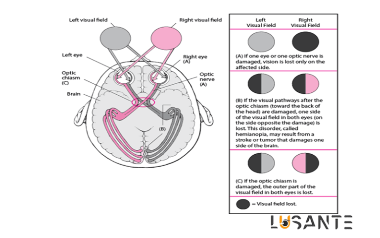 Transient Vision Loss: white out vs. black out | 10 Causes, Symptoms